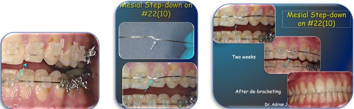 January's Tip: Second Order Wire Bends Step-up and Step-down Arch Wire ...