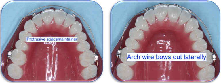August's Tip: Orthodontic Loops in Straight Wire System, Part III ...