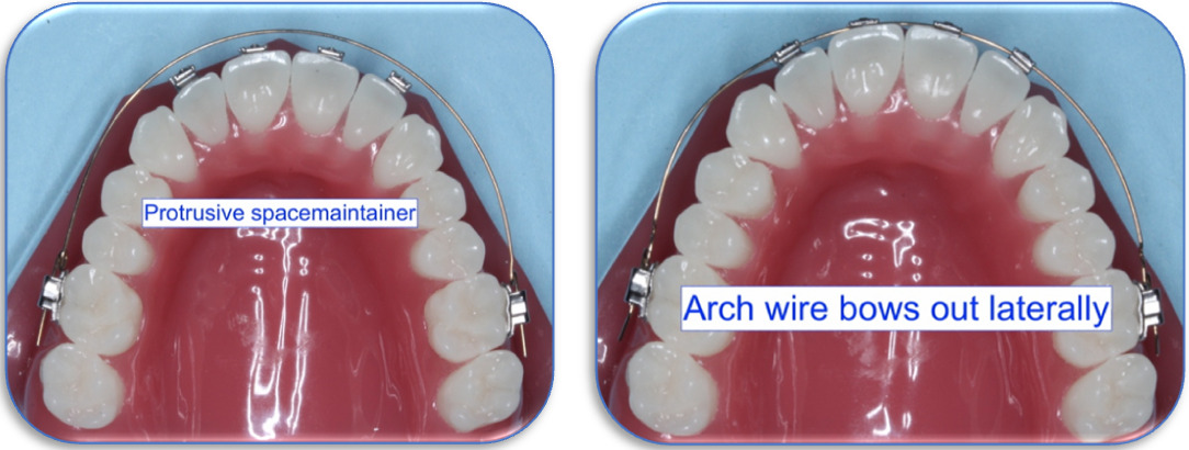 Helical Loop Orthodontic Space Maintainer for Anterior Teeth