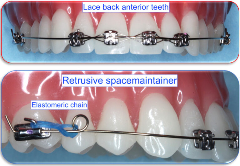 August's Tip: Orthodontic Loops in Straight Wire System, Part III ...