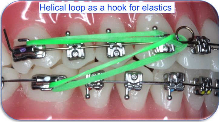Helical Loop Orthodontic Anchor for Elastics & Space Closure