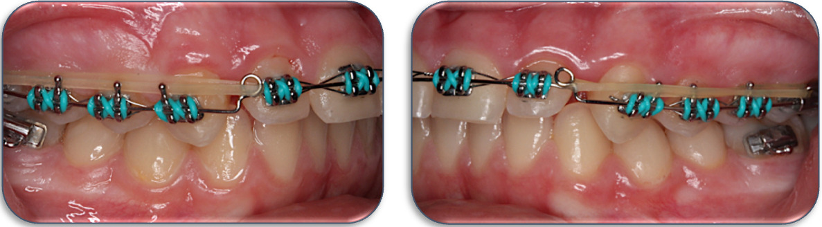 September's Tip: Orthodontic Loops in Straight Wire System, Part IV ...