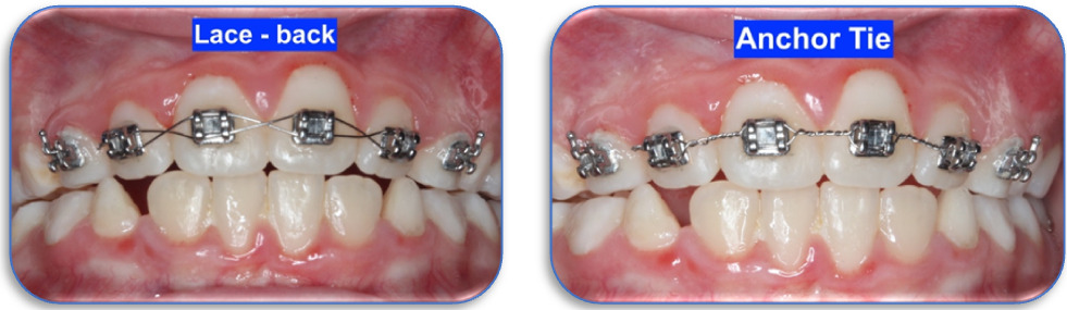 Stainless Steel Ligature Tie Orthodontics Techniques & Uses