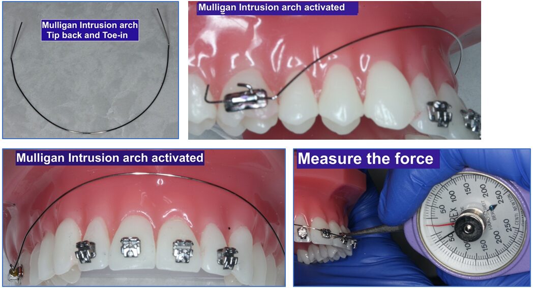 October's Tip: Mulligan Mechanics Part IV Mulligan Intrusion Arch ...