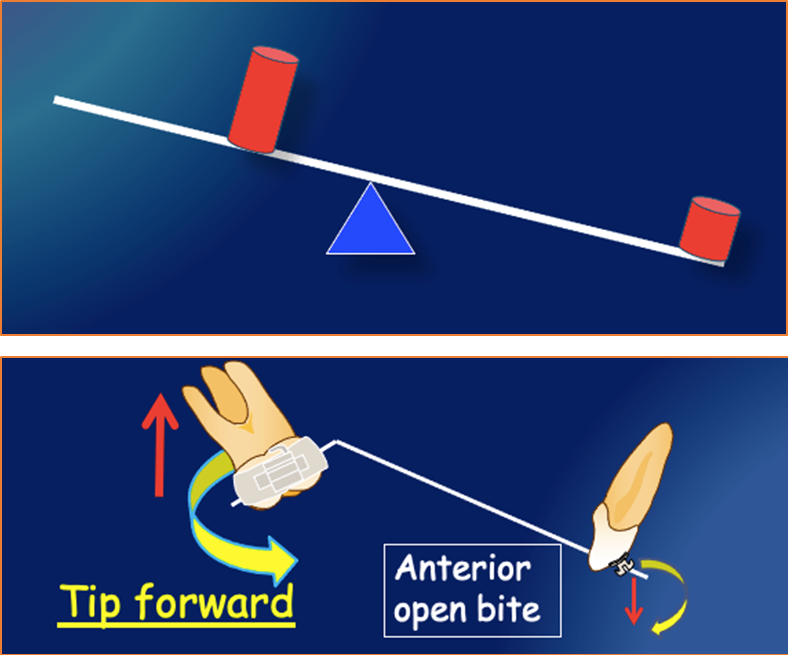 November's Tip: Mulligan Mechanics Part V Mulligan Extrusion Arch ...