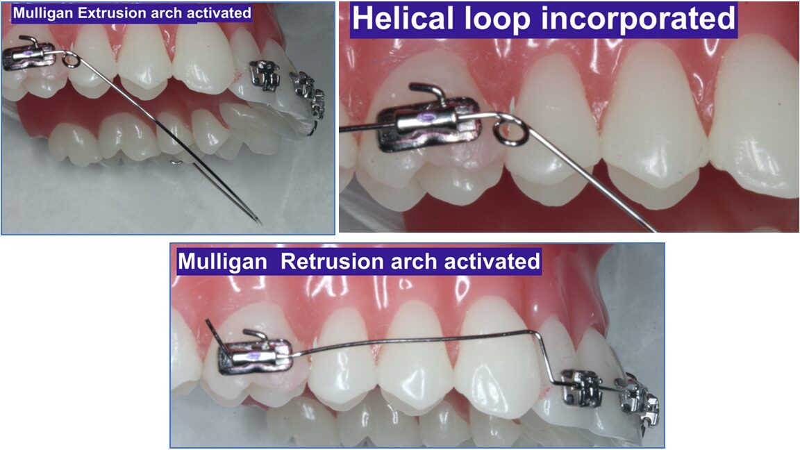Mulligan Extrusion Arch for Incisor Control & Molar Effects