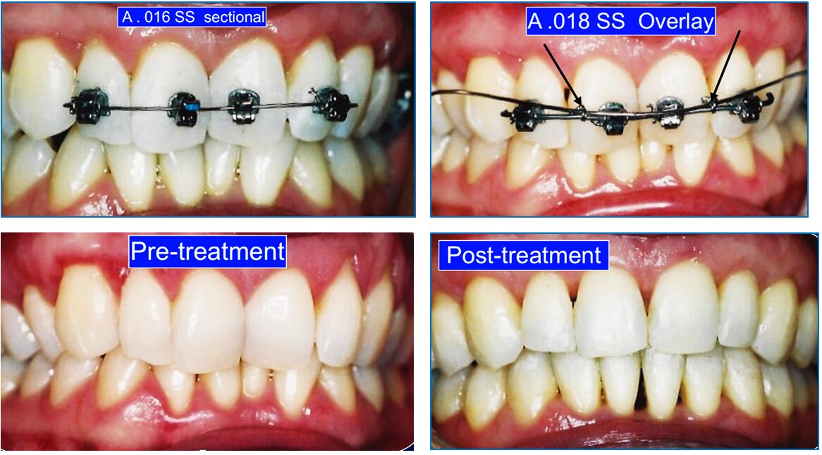 Mulligan Overlay Arch for Sagittal Bite Correction Cases